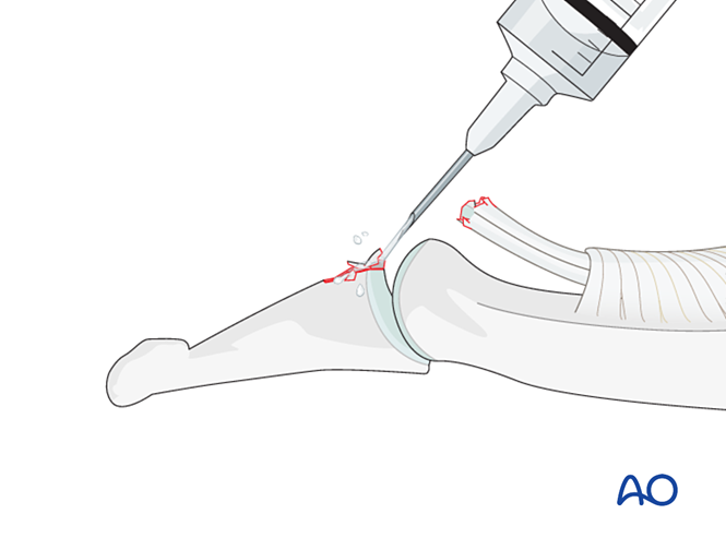 Suture fixation for Palmar avulsion injury of the proximal end segment