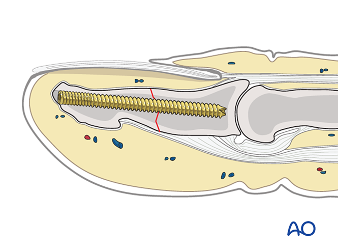 Cannulated screw fixation for Simple fracture of the diaphysis and ...
