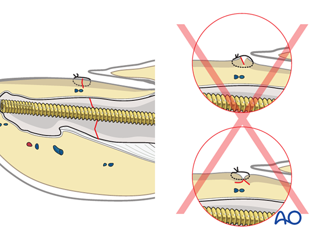 Cannulated screw fixation for Simple fracture of the diaphysis and ...
