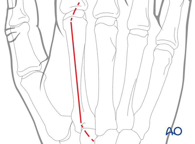 Dorsal approach to the metacarpals