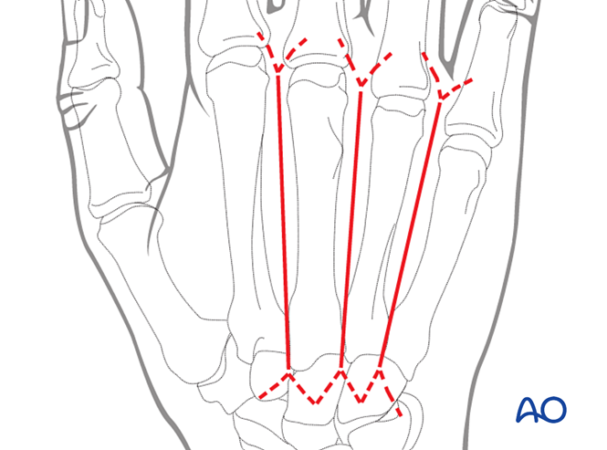 Dorsal approach to the metacarpals