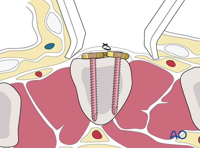 Dorsal approach to the metacarpals
