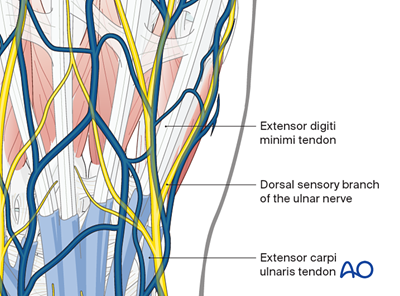 Dorsal approach to the 5th carpometacarpal joint
