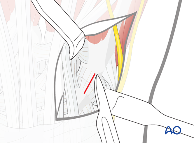 Dorsal approach to the 5th carpometacarpal joint
