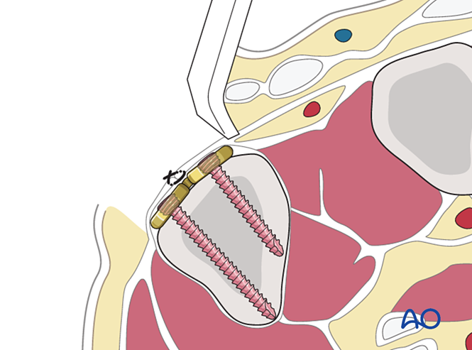 Dorsal approach to the 5th carpometacarpal joint