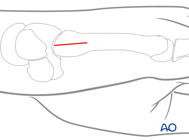 Dorsoulnar Approach To The 5th Metacarpal Base