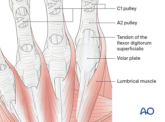 Volar approach to the metacarpophalangeal joint