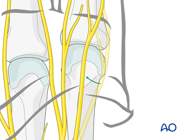 Volar approach to the metacarpophalangeal joint