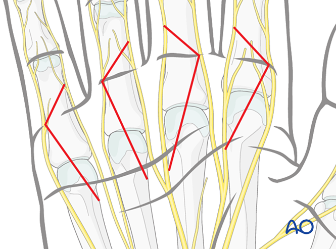 Volar approach to the metacarpophalangeal joint