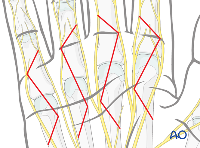 Volar approach to the metacarpophalangeal joint