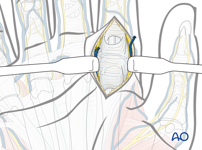 Volar approach to the metacarpophalangeal joint