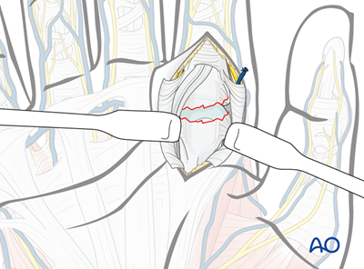 Volar approach to the metacarpophalangeal joint