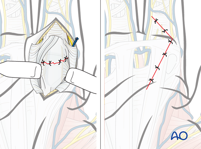 Volar approach to the metacarpophalangeal joint