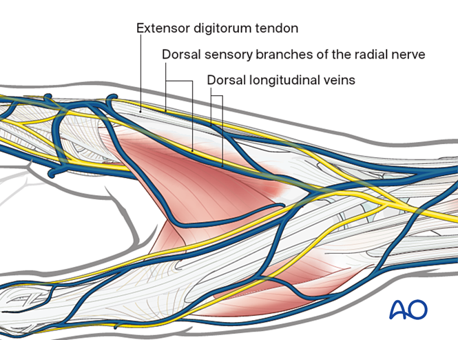 Radial approach to the 2nd metacarpal