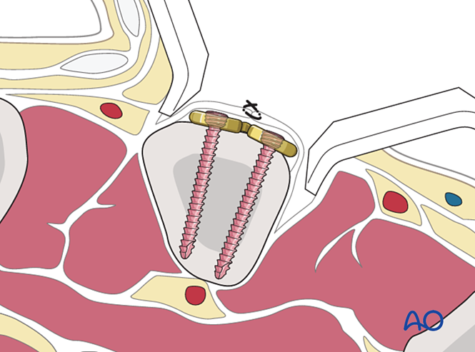 Radial Approach To The 2nd Metacarpal