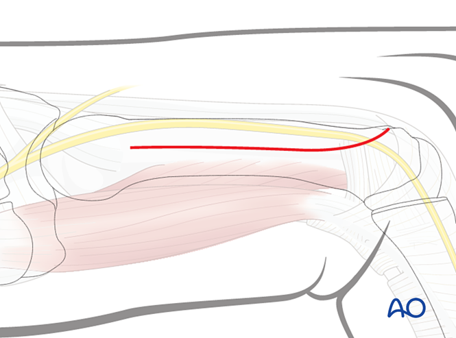 Dorsoulnar approach to the 5th metacarpal