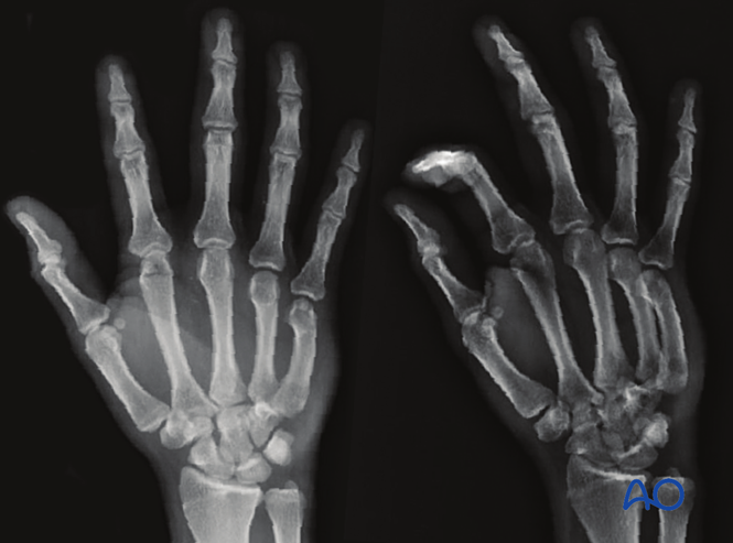 Dislocation and fracture-dislocation of the carpometacarpal joint