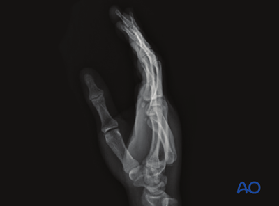 Dislocation and fracture-dislocation of the carpometacarpal joint