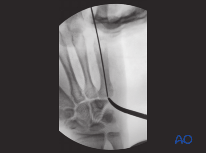 Intramedullary screw fixation for Simple transverse fracture of the ...