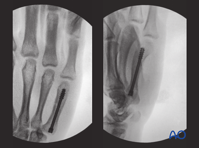 Intramedullary screw fixation for Simple transverse fracture of the ...