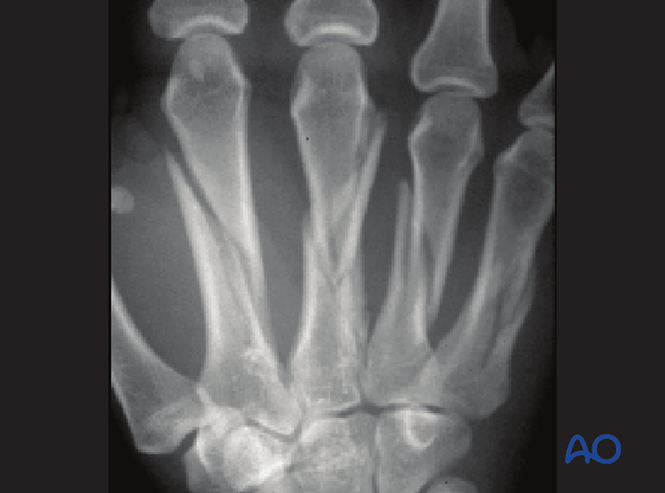 Bridge plating for Extraarticular fracture of the proximal end segment