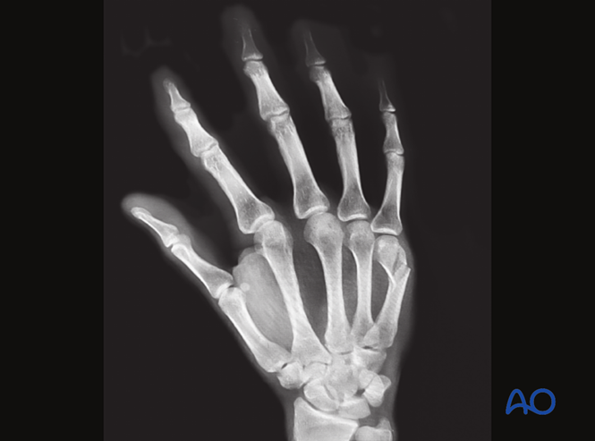 Extraarticular fracture of the distal end segment