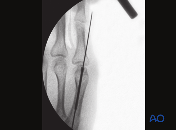 Intramedullary screw fixation for Extraarticular fracture of the distal ...
