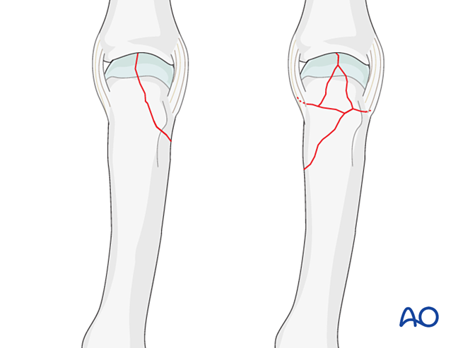 Articular fracture of the distal end segment