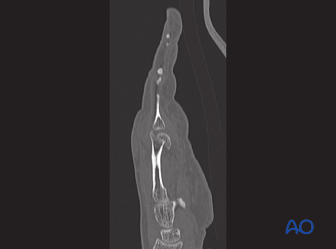 Articular fracture of the distal end segment