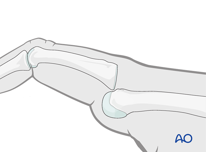 Dislocation and fracture-dislocation of the metacarpophalangeal joint