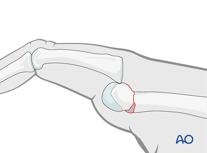 Dislocation and fracture-dislocation of the metacarpophalangeal joint