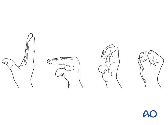 Closed reduction - Splinting for Extraarticular fracture of the ...