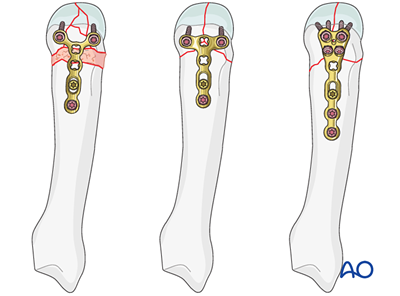 Plating for Articular fracture of the distal end segment