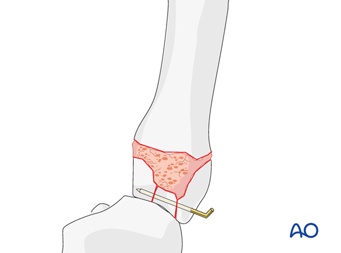 Plating for Complete articular fracture of the proximal end segment