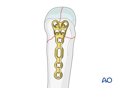 Plating for Articular fracture of the distal end segment