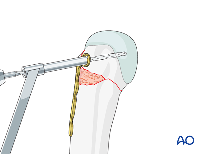 Plating for Articular fracture of the distal end segment