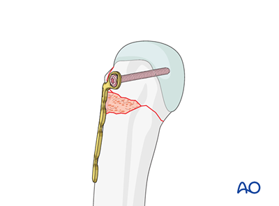 Plating for Articular fracture of the distal end segment