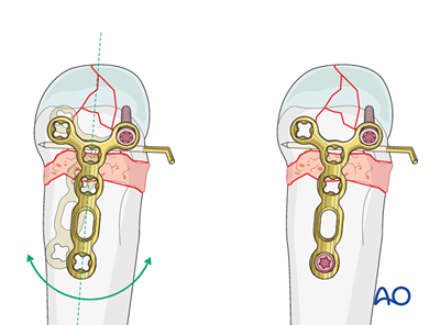 Plating for Articular fracture of the distal end segment