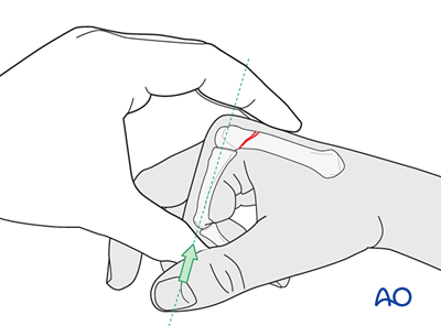 Closed reduction - Splinting for Extraarticular fracture of the distal ...