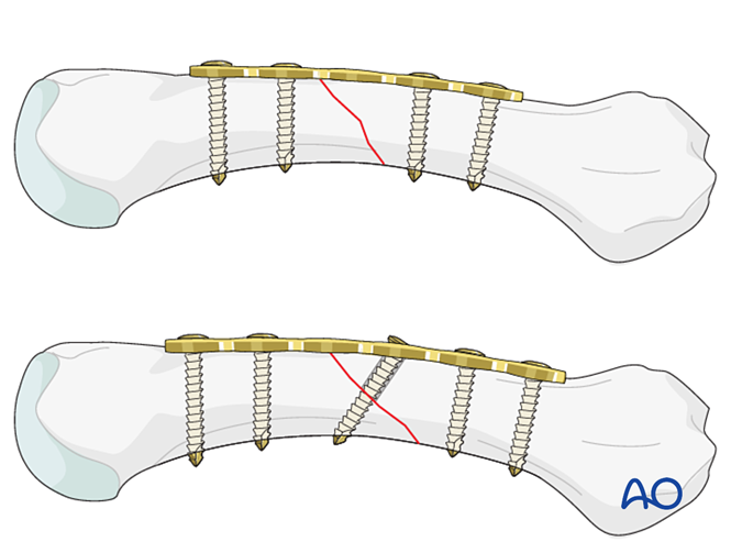 Compression plating with/without lag screw for Simple oblique fracture ...