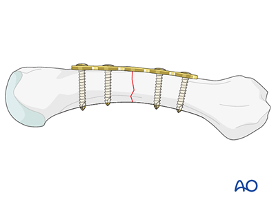Compression plating for Simple transverse fracture of the diaphysis