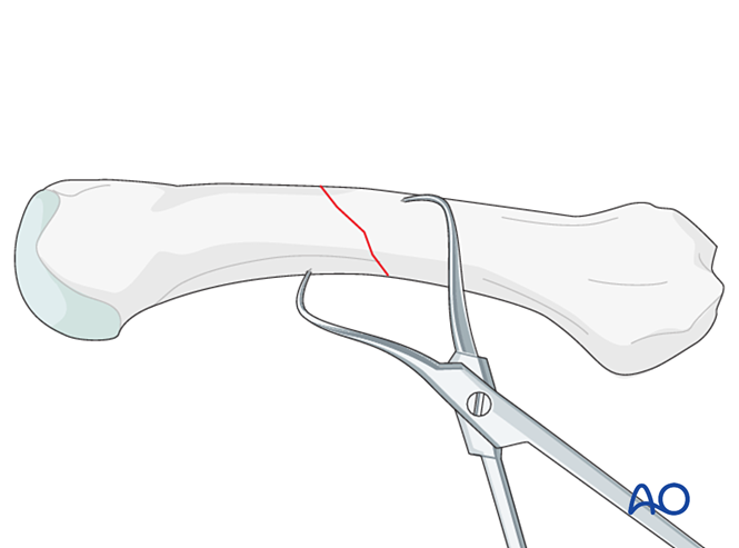 Compression plating with/without lag screw for Simple oblique fracture ...