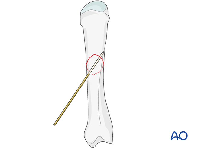 Compression plating with/without lag screw for Simple oblique fracture ...