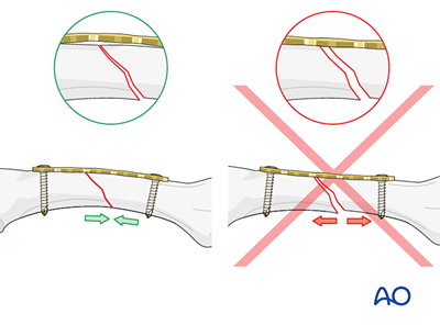 Compression plating with/without lag screw for Simple oblique fracture ...