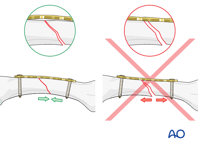 Compression plating with/without lag screw for Simple oblique fracture ...
