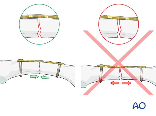 Compression plating for Simple transverse fracture of the diaphysis