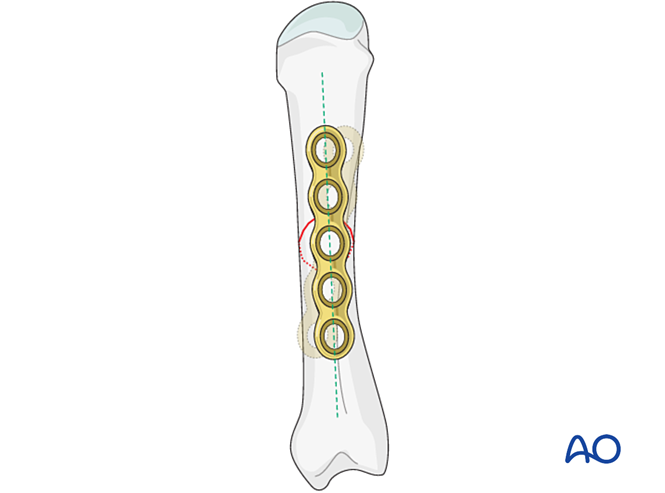 Compression plating with/without lag screw for Simple oblique fracture ...