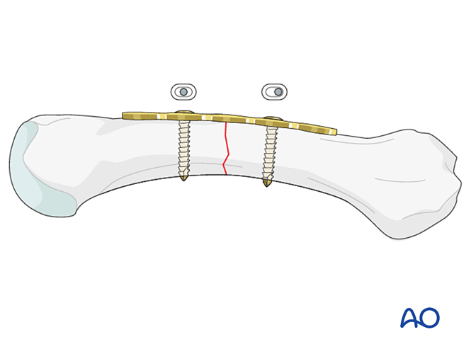 Compression plating for Simple transverse fracture of the diaphysis