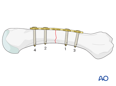 Compression plating for Simple transverse fracture of the diaphysis
