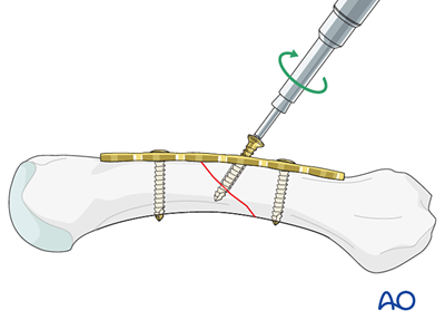 Compression plating with/without lag screw for Simple oblique fracture ...